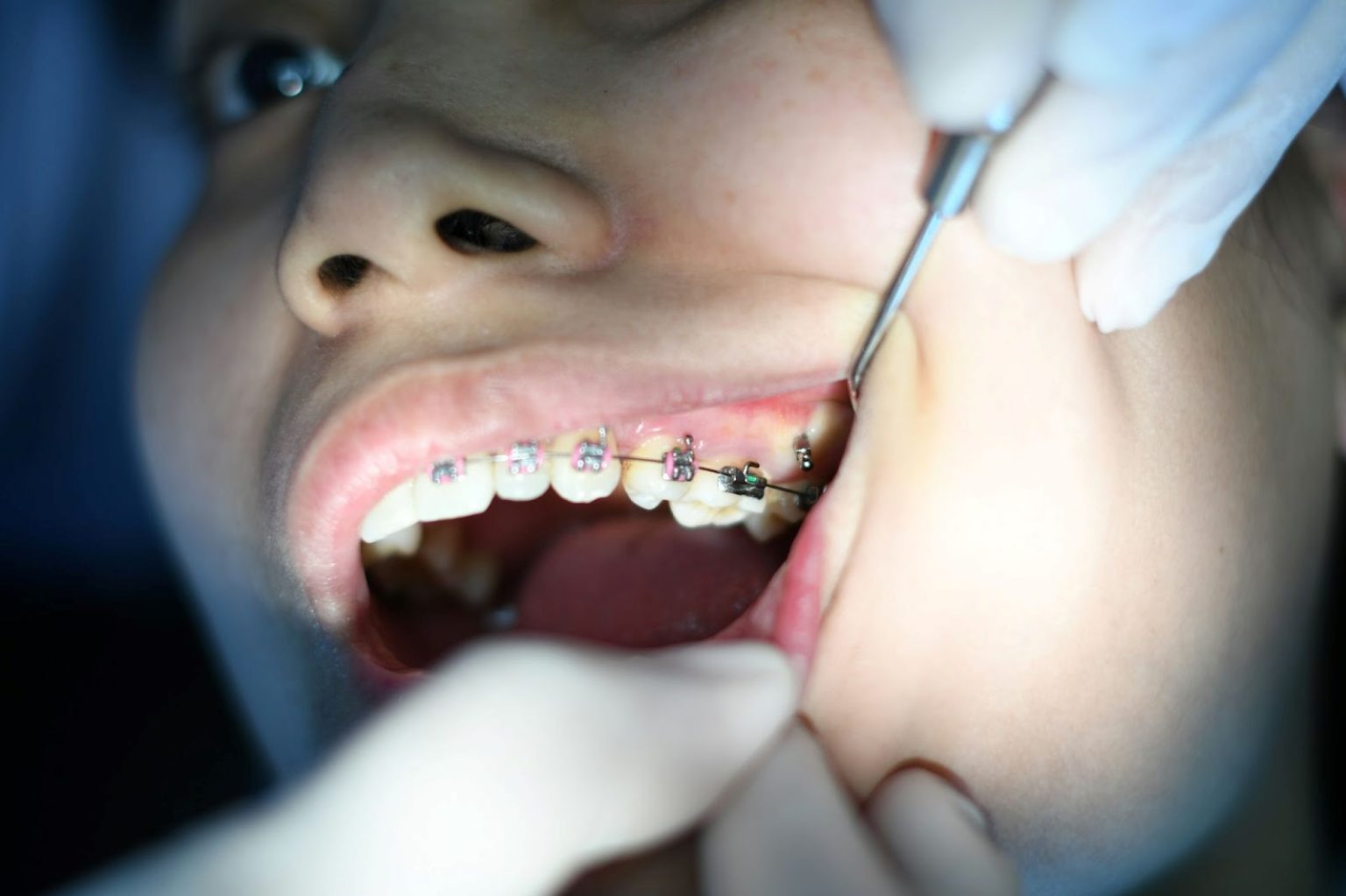 How can braces fix jaw alignment? ~ [The Science Behind It]